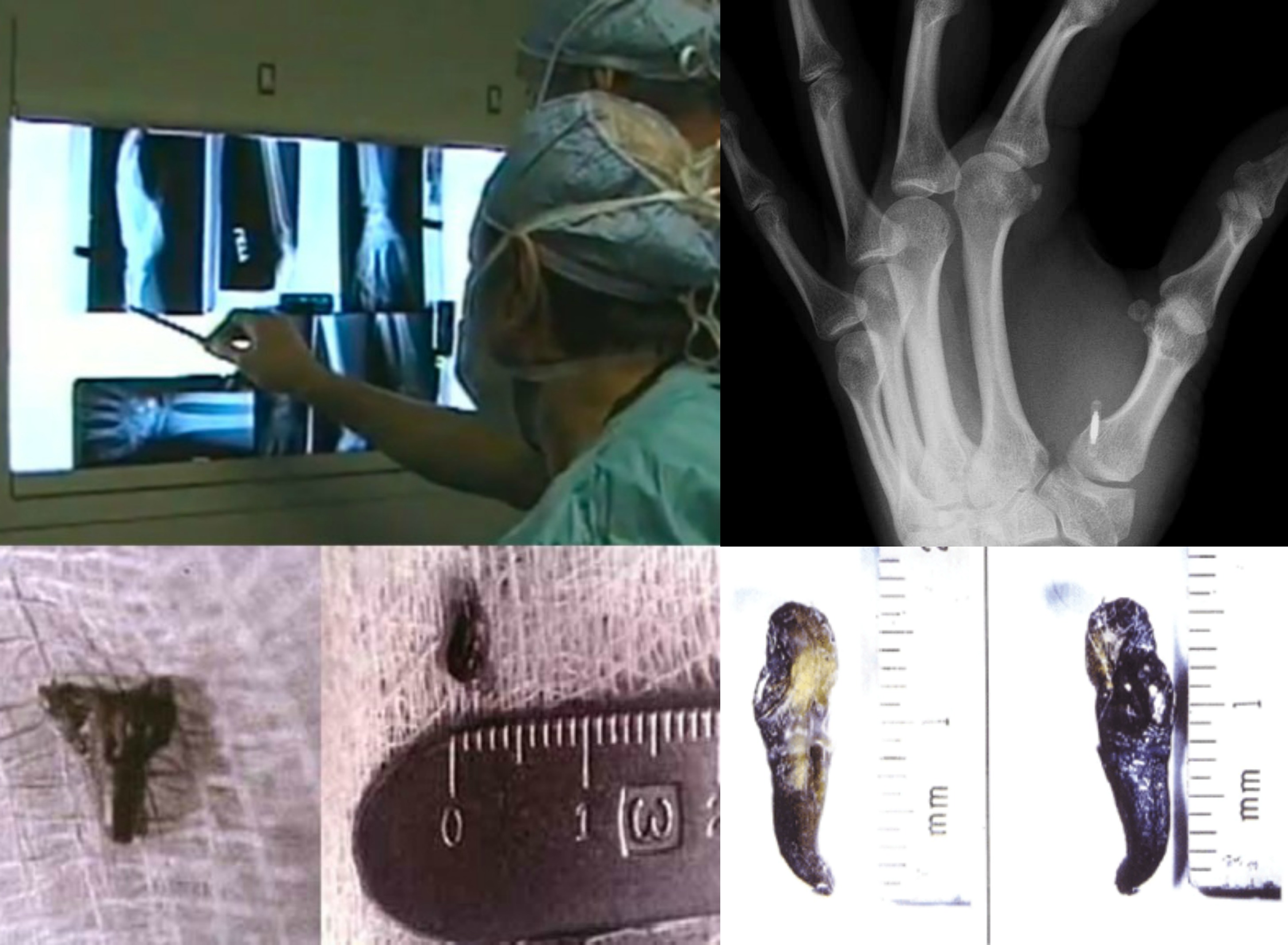 La Fotografa De Estefana Borge Cuando Tena Implantes En